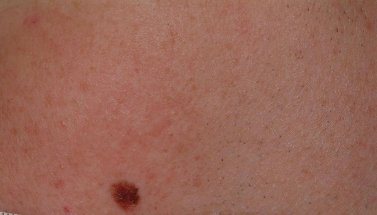 Skin Cancer Red Patch On FaceDownload Free Software Programs Online Skin Cancer Red Patch On FaceDownload Free Software Programs Online