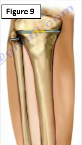 Growth Plate Injuries | HuffPost Life